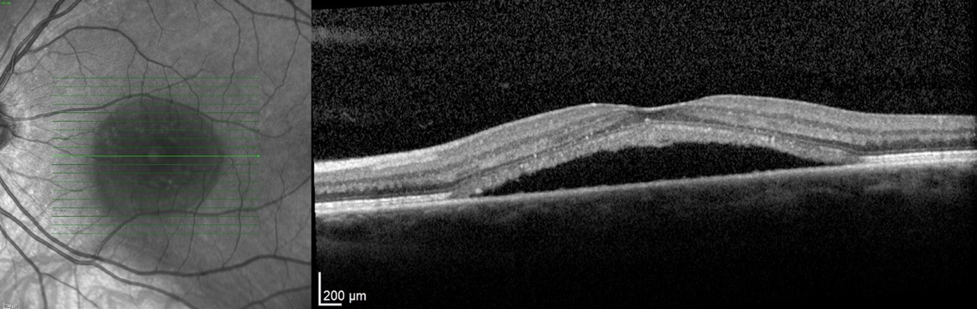 Central Serous Chorioretinopathy: Evolving Understanding ...