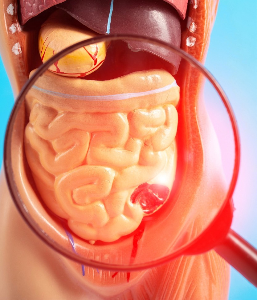 AbbVie’s Skyrizi approved by FDA for UC treatment