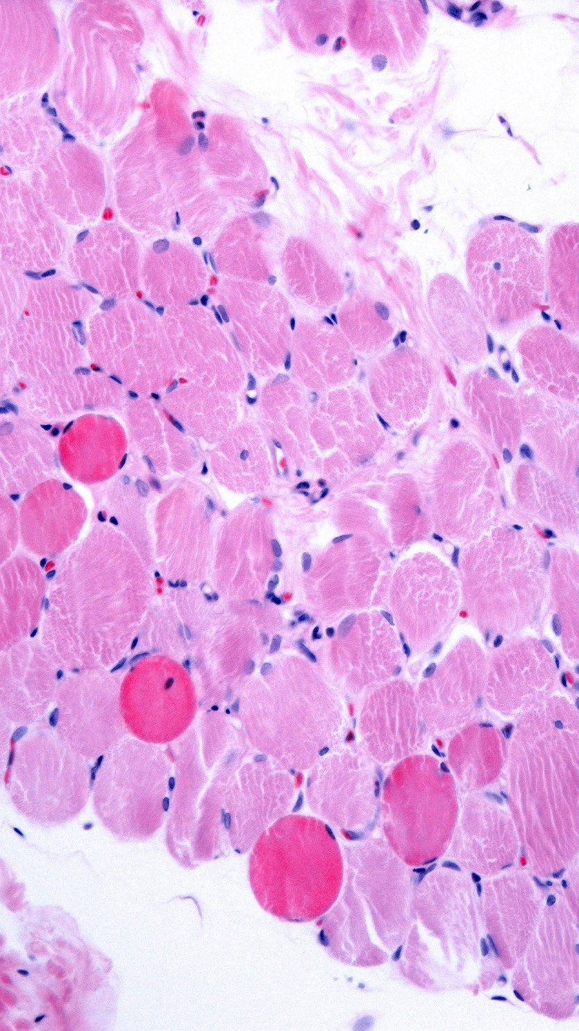 FDA expands approval for Sarepta Therapeutics’ DMD treatment