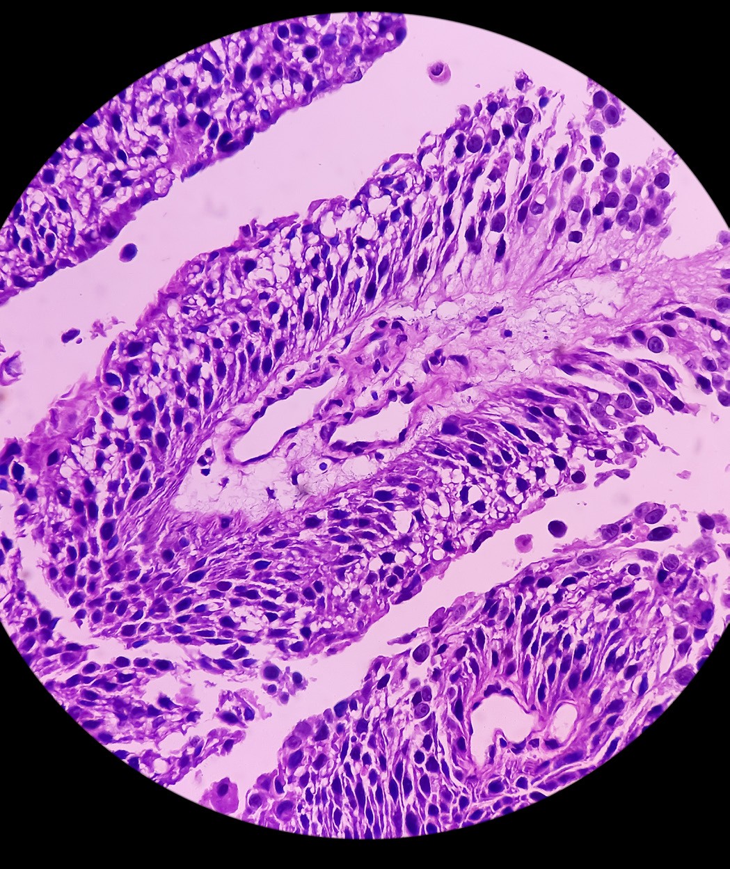 CHMP gives positive opinion for Merck’s KEYTRUDA for unresectable or ...