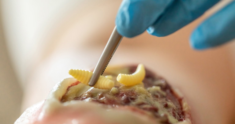 Five Facts About Medical Maggot Therapy