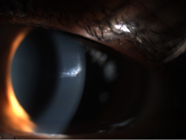 Advancing Outcomes: MS-39 AS-OCT & Osiris-T Aberrometer