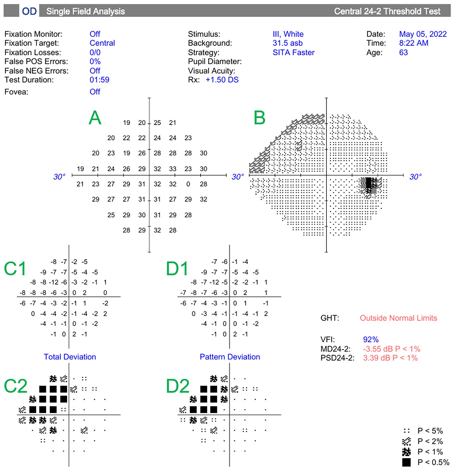 Visual Field Testing: A Guide to Interpreting Reports