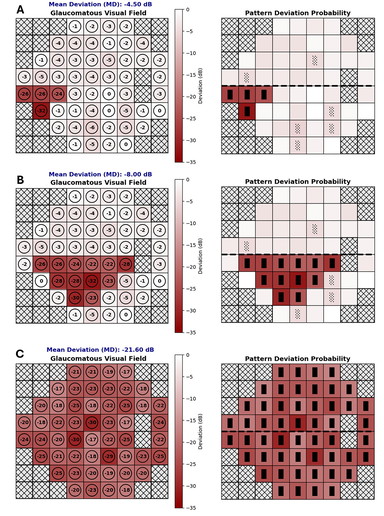 Visual Field Testing: A Guide to Interpreting Reports